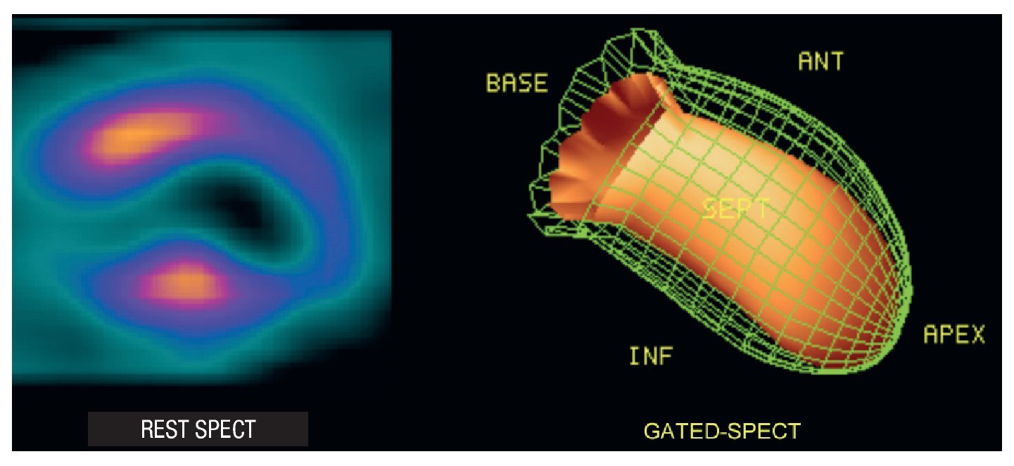 Ischemic Cardiomyopathy: A Clinical Nuclear Cardiology Perspective ...