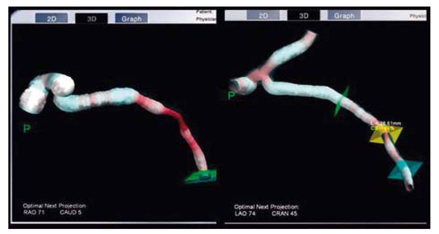 Stereotaxis: A New Approach to Treating Highly Tortuous and Angulated ...