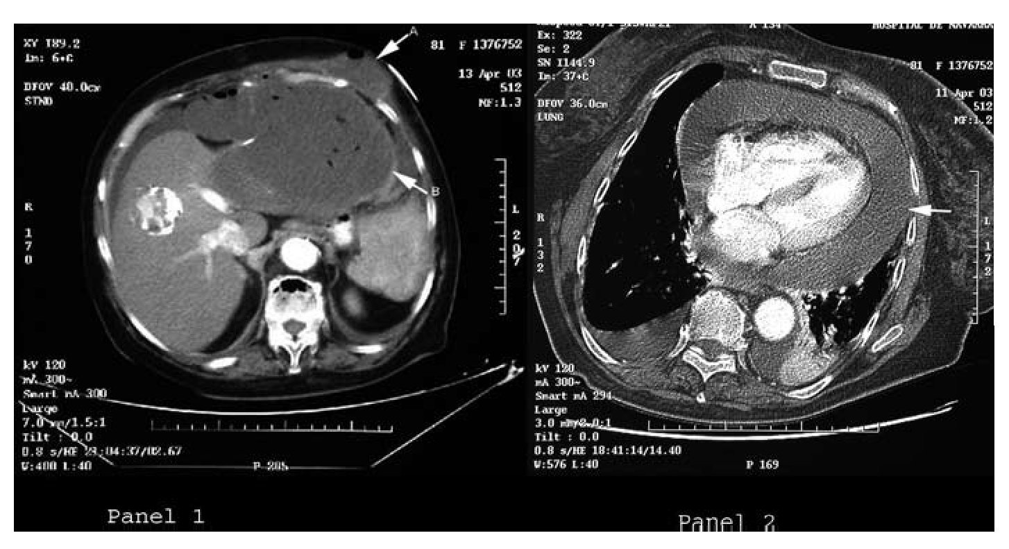 Purulent Pericarditis Complicated by Cardiac Tamponade Secondary to a ...
