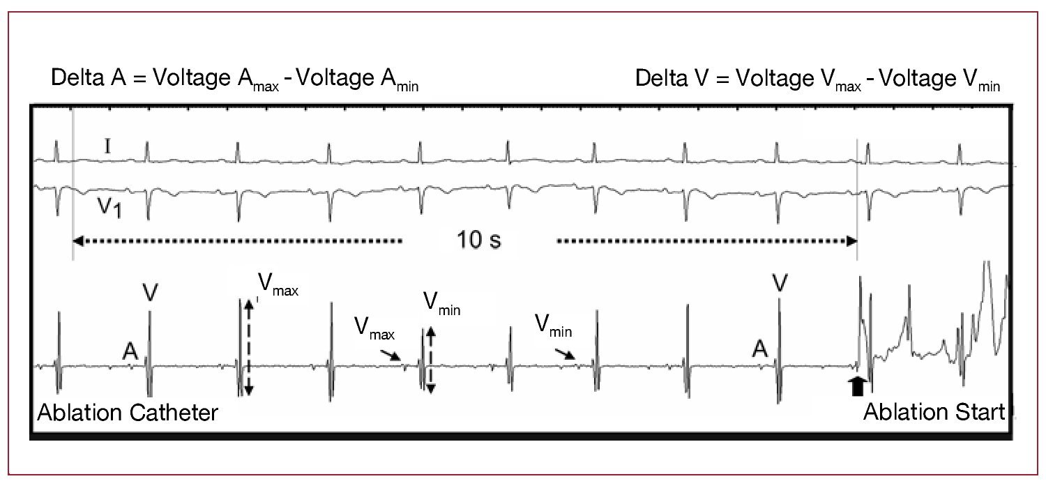 Ablation of Atrioventricular Nodal Reentrant Tachycardia Using Remote ...