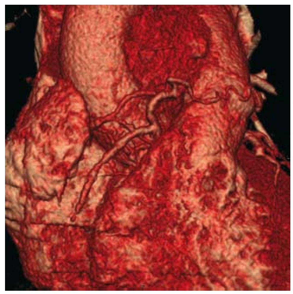 Aortic Paraganglioma