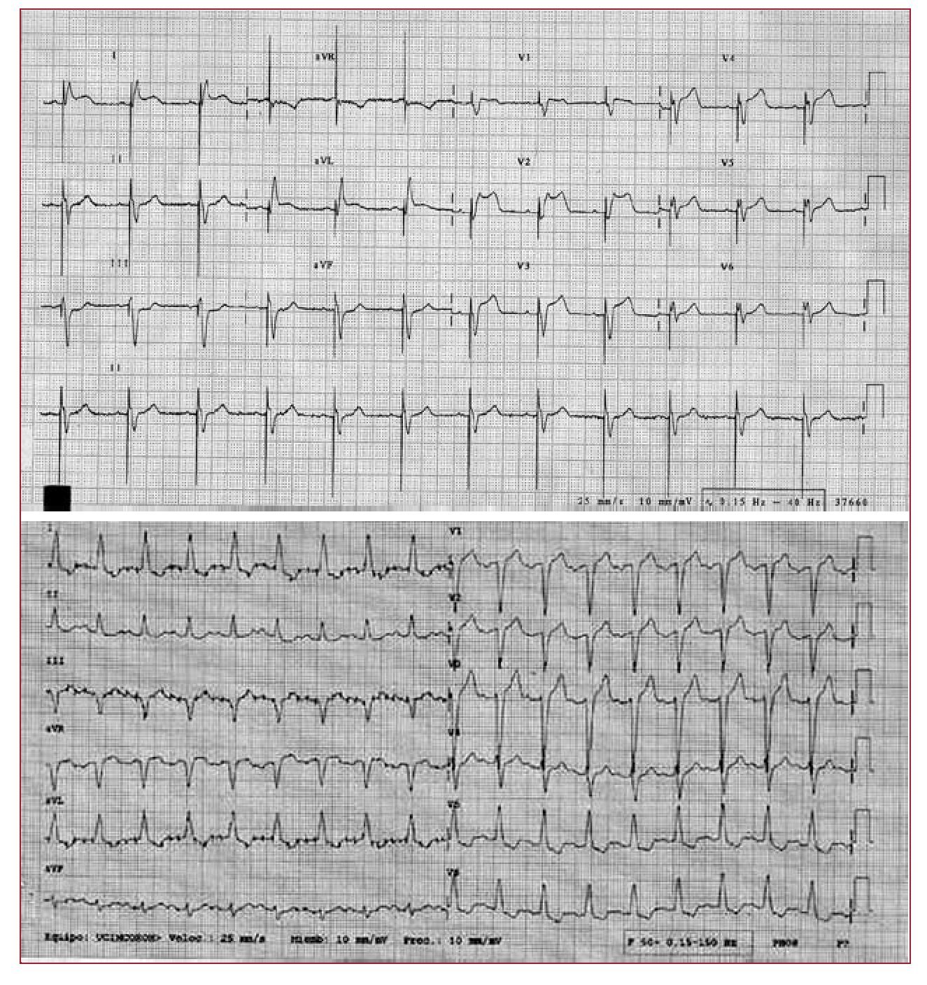 Electrocardiographic Diagnosis of Acute Coronary Syndrome in Patients ...
