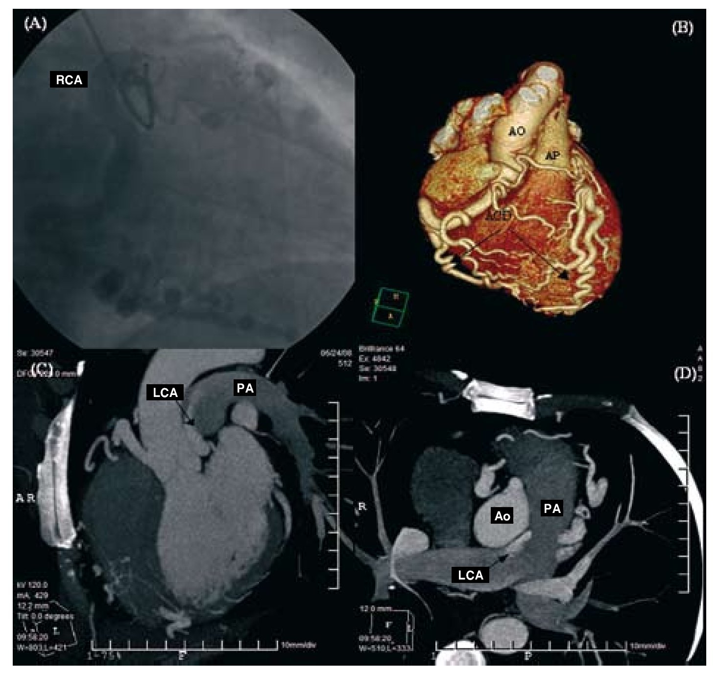 Diagnosis of ALCAPA Syndrome in Adults | Revista Española de Cardiología