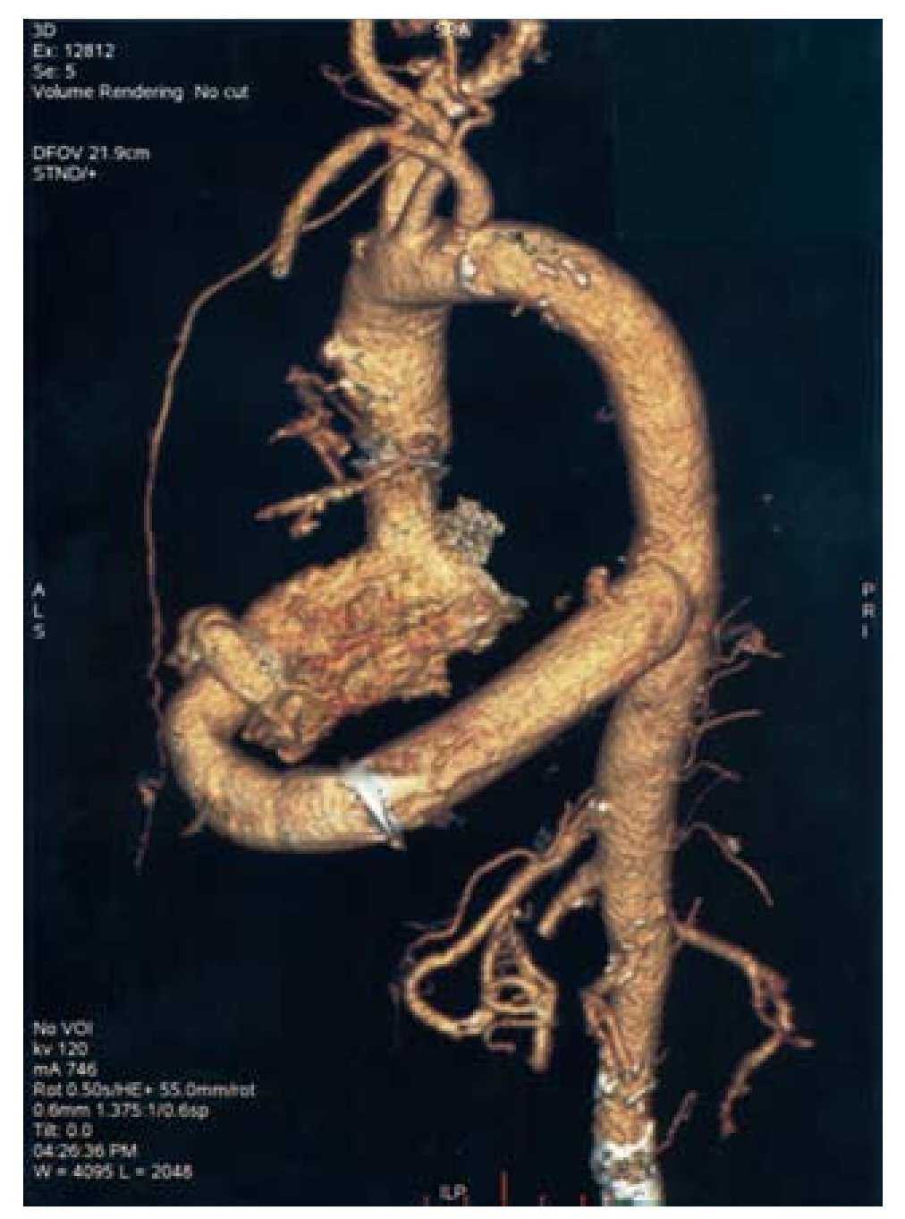 An Apico-Aortic Conduit in a Case of Patient-Prosthesis Mismatch ...