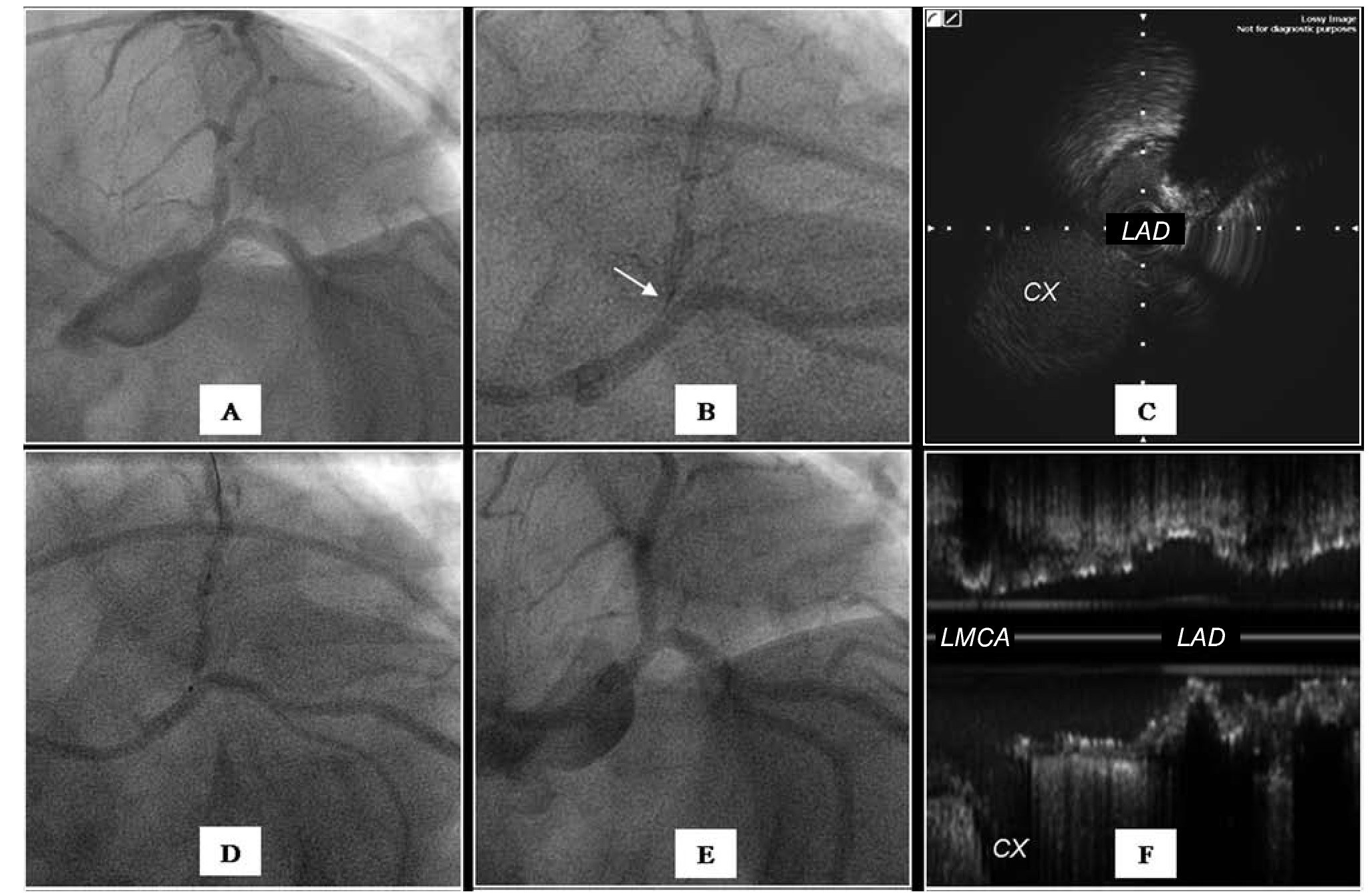 Vulnerable Carina Anatomy and Ostial Lesions in the Left Anterior ...