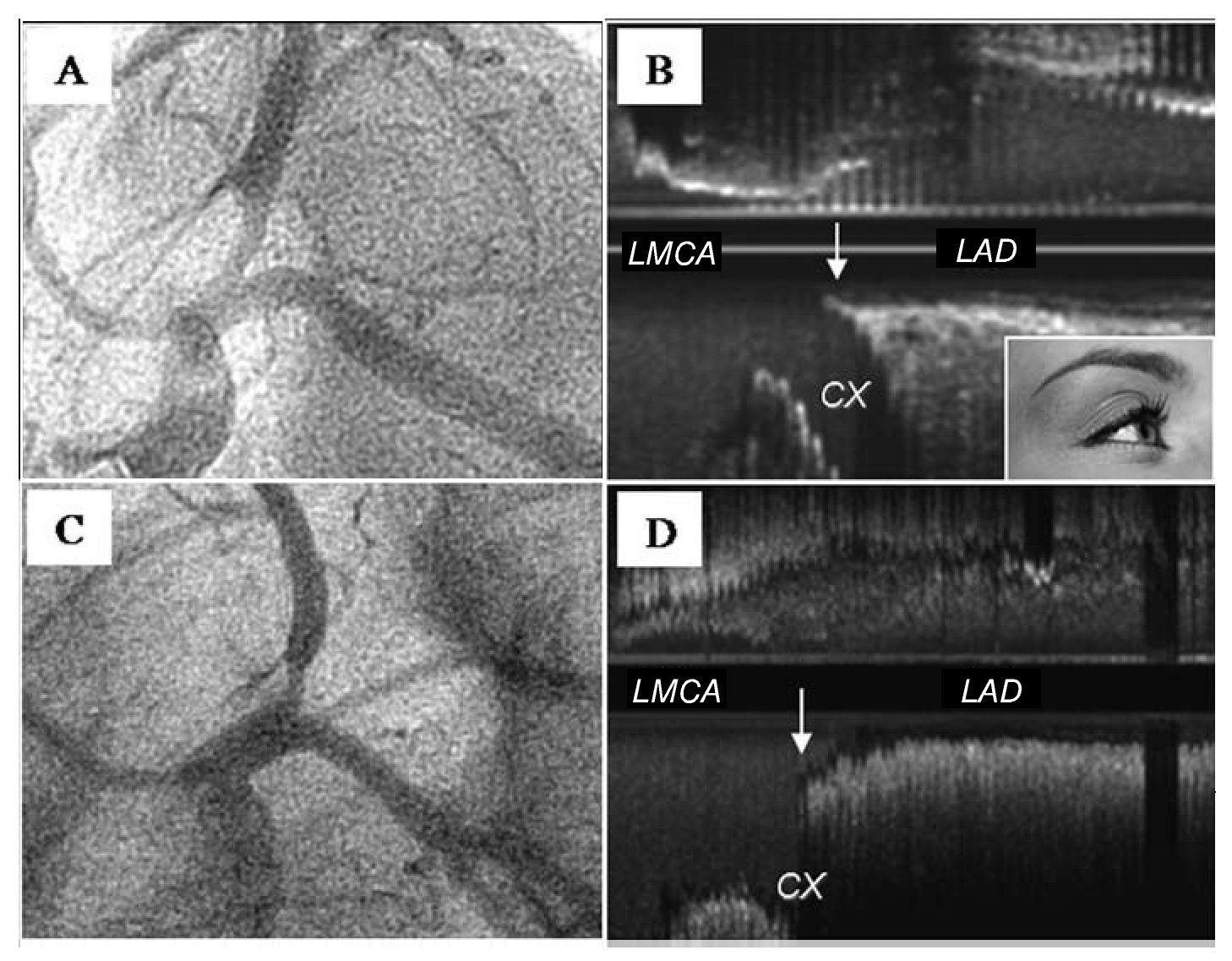Vulnerable Carina Anatomy and Ostial Lesions in the Left Anterior ...