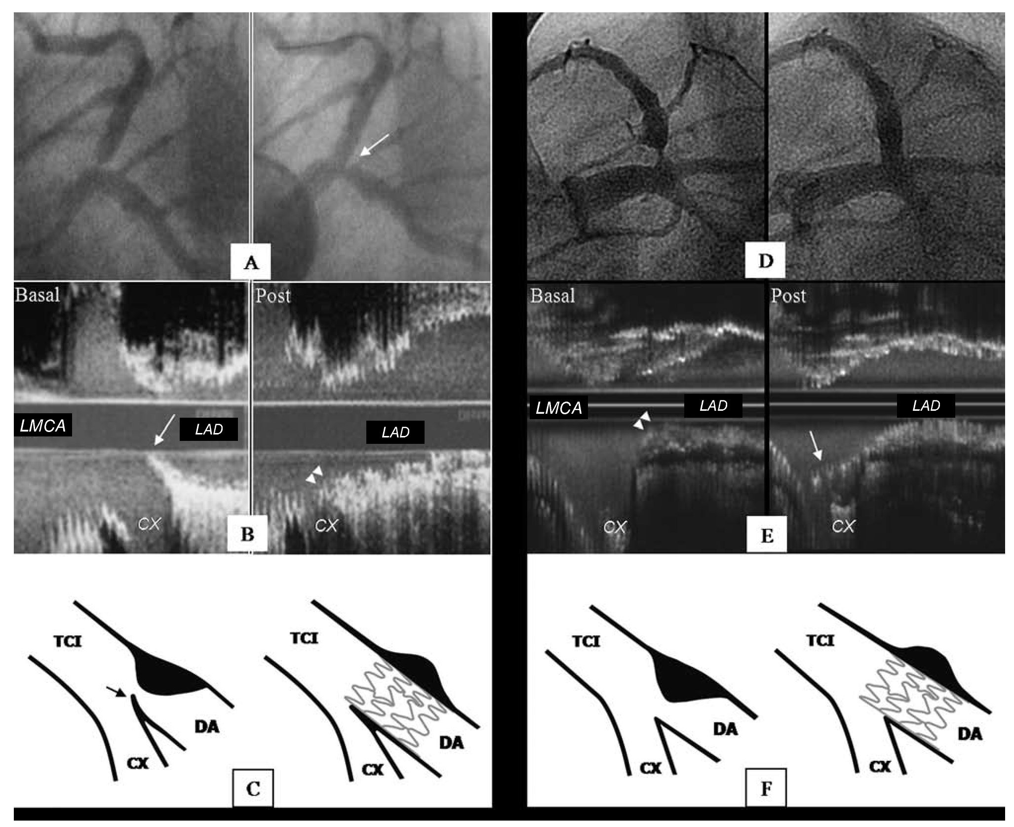 Vulnerable Carina Anatomy and Ostial Lesions in the Left Anterior ...