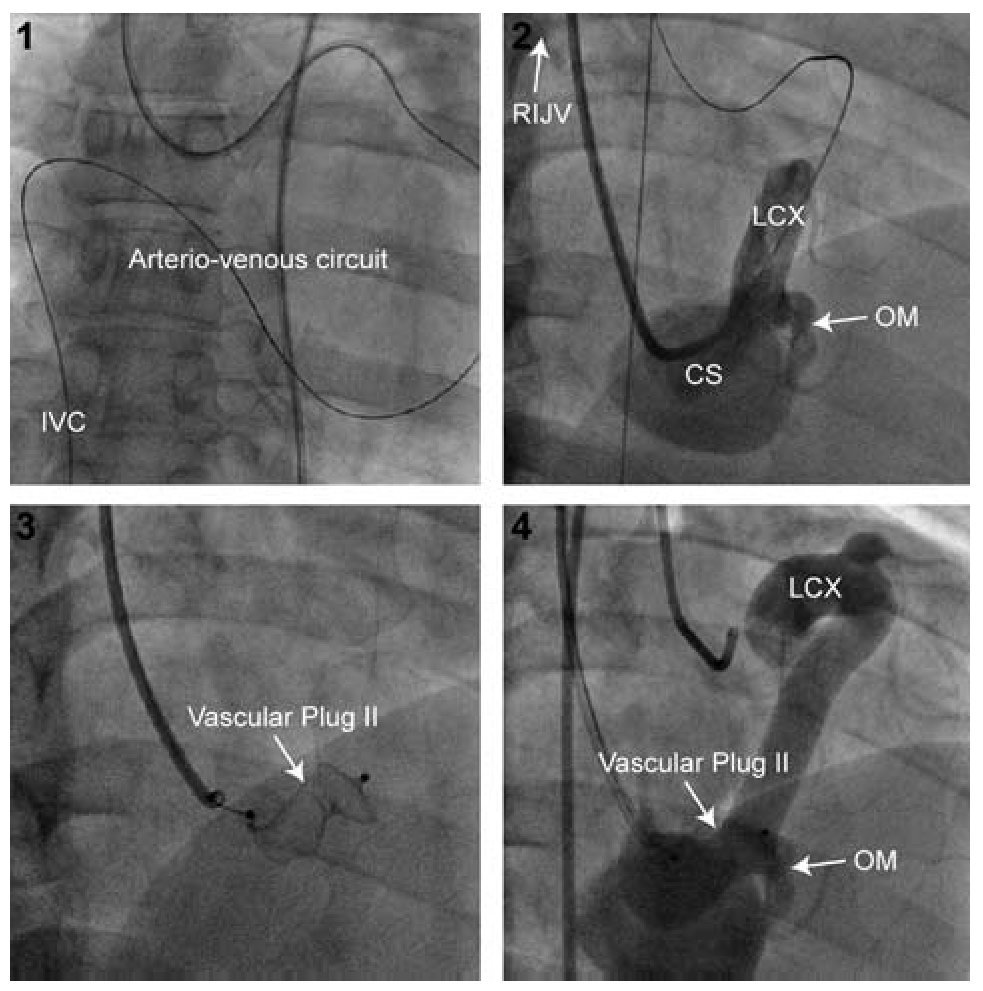 Transcatheter Closure of Coronary Artery Fistulas | Revista Española de ...
