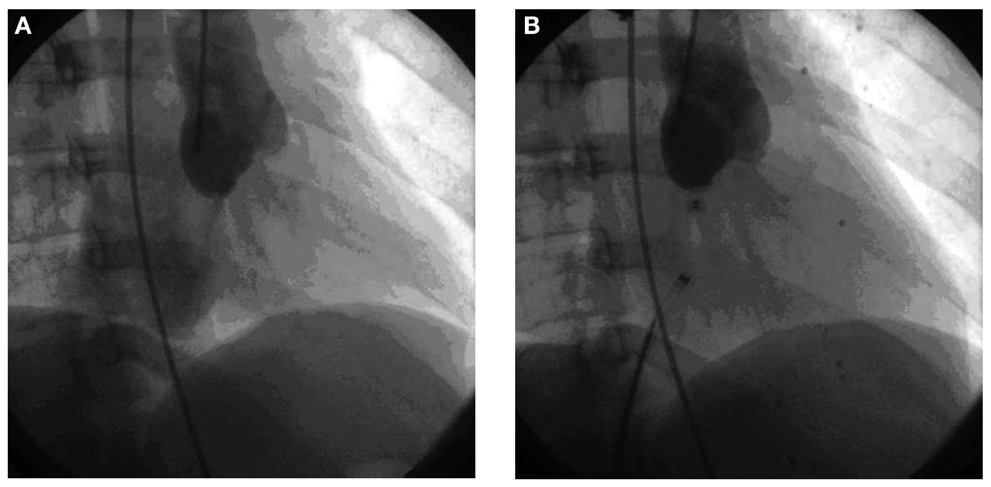 Transcatheter Closure of Ruptured Sinus of Valsalva Aneurysms With An ...