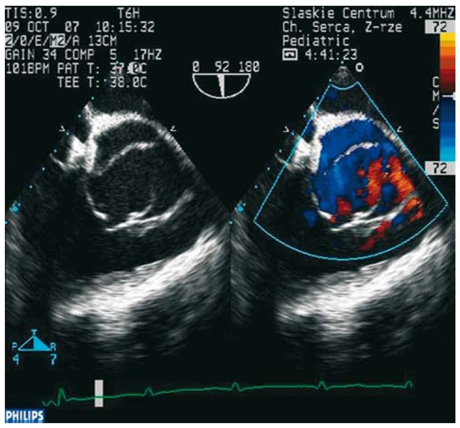 Transcatheter Closure of Ruptured Sinus of Valsalva Aneurysms With An ...