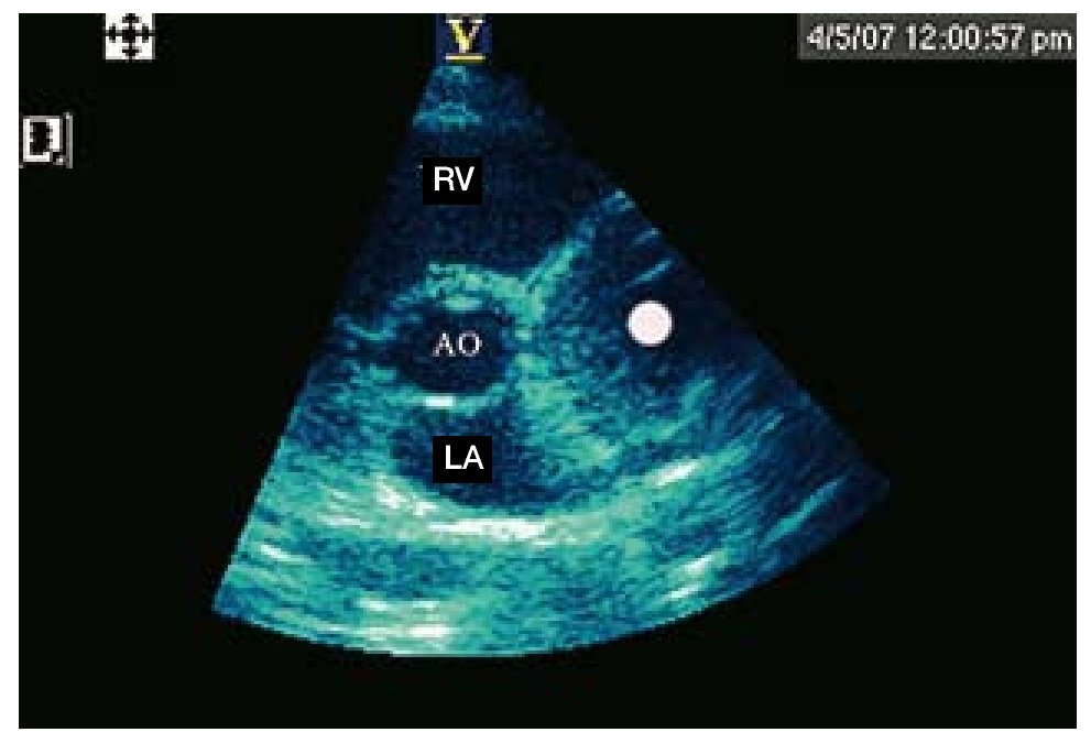 Intrapericardial Paraganglioma | Revista Española de Cardiología