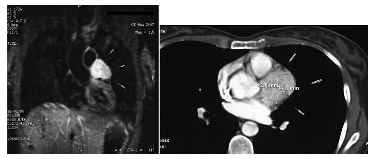 Intrapericardial Paraganglioma | Revista Española de Cardiología
