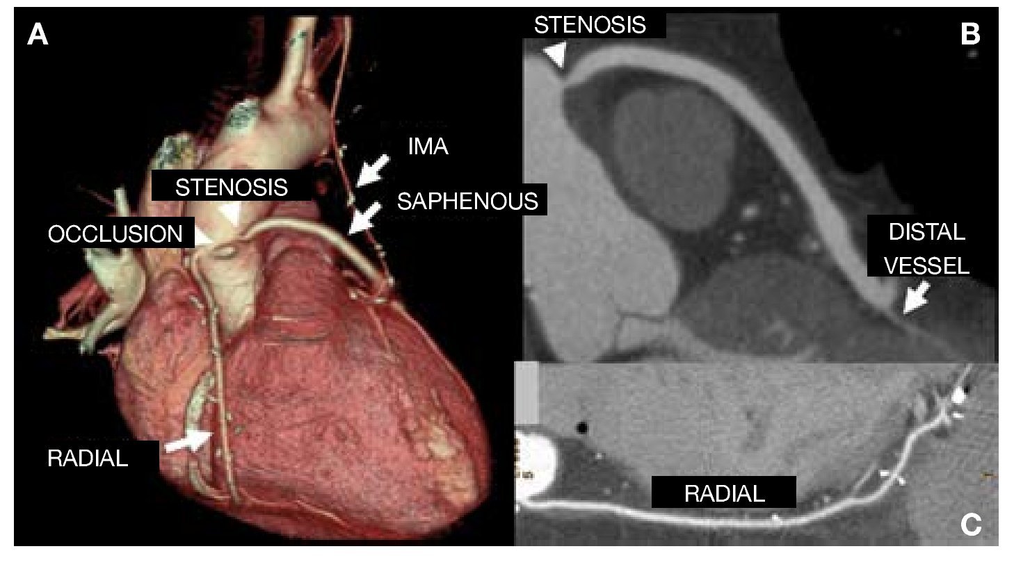 Non-Invasive Assessment of Coronary Artery Bypass Grafts and Native ...