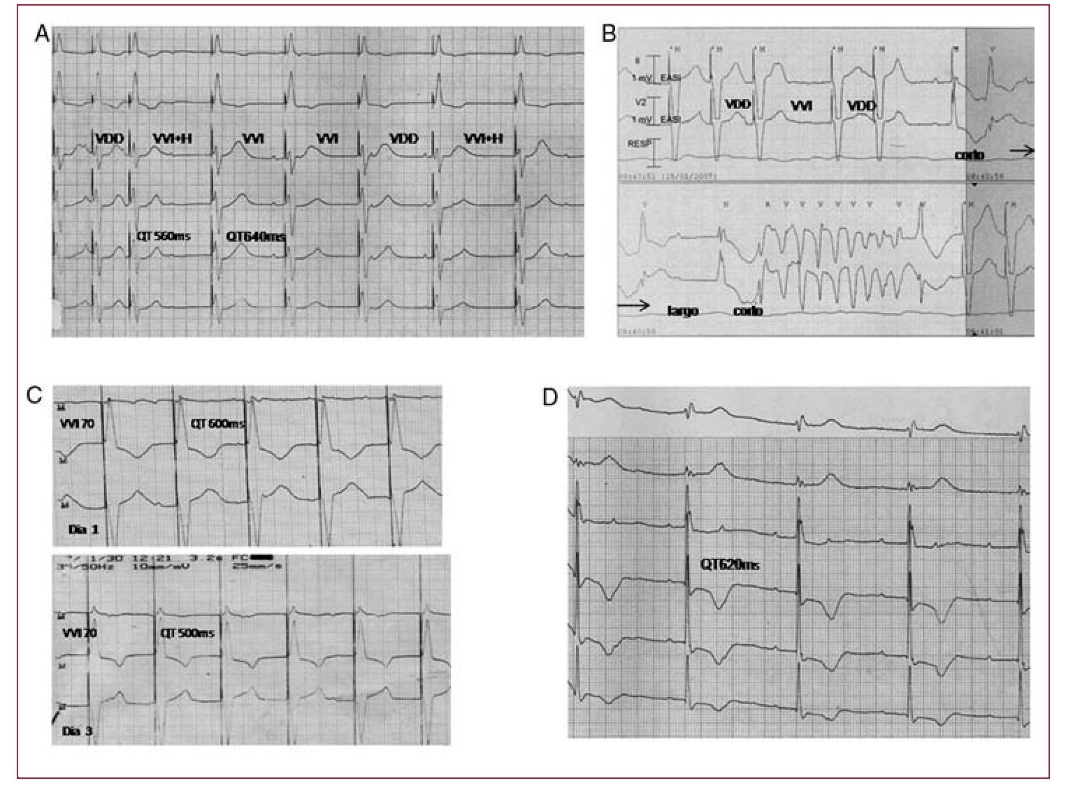 Intermittent Atrial Undersensing in Single-Lead VDD Pacemakers in ...