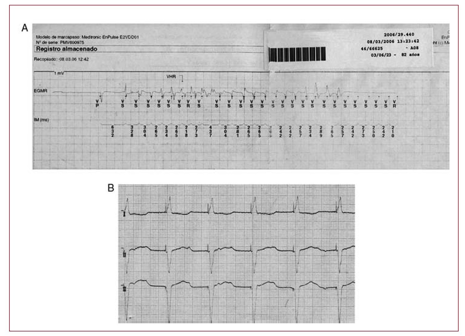 Intermittent Atrial Undersensing in Single-Lead VDD Pacemakers in ...