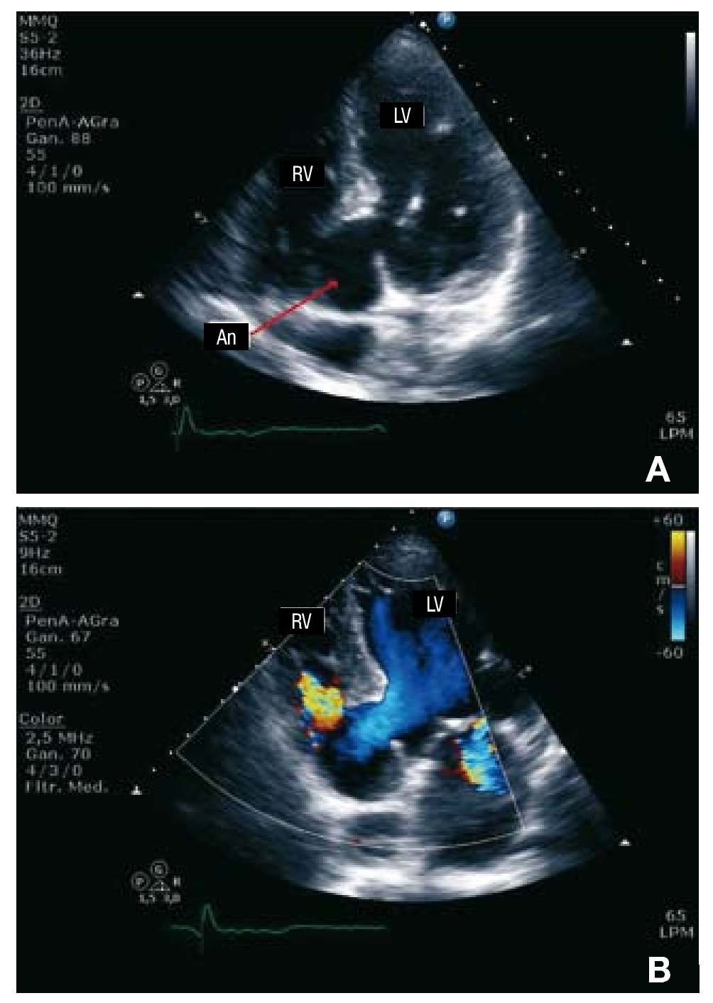Interventricular Septal Aneurysm With Fistulas Developing Into the ...