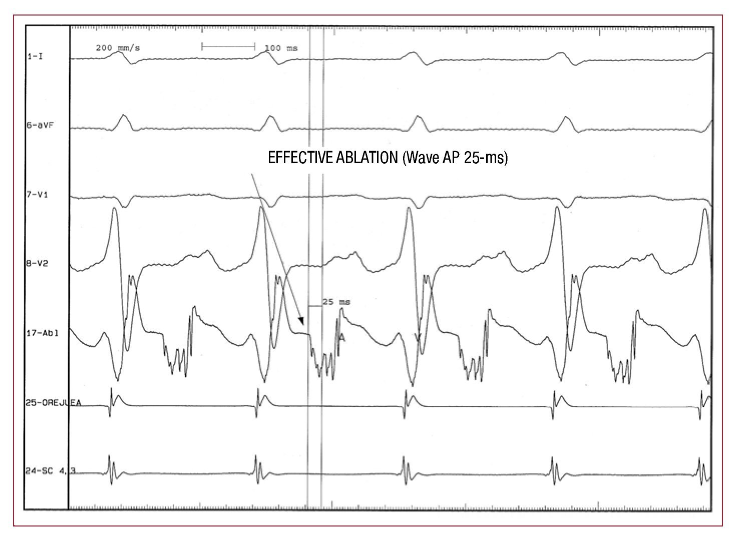 Radiofrequency Ablation of Left Atrial Tachycardia in a Three-Month-Old ...