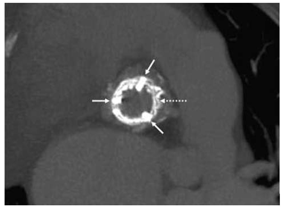 Transapical Valve-in-Valve Implantation as a Treatment Option for ...