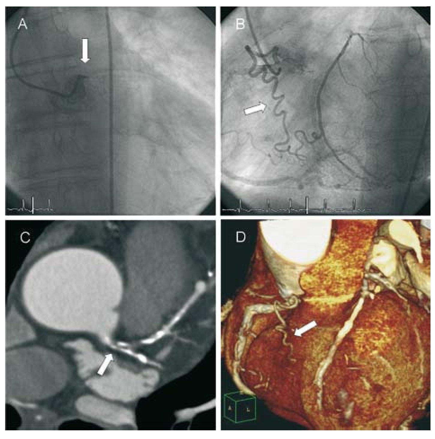 Collateral Circulation From the Conus Coronary Artery to the Anterior ...