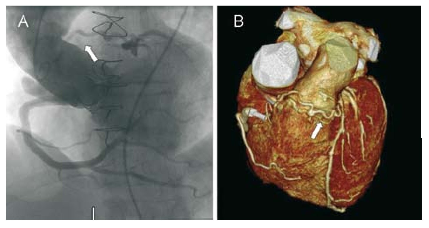 Collateral Circulation From the Conus Coronary Artery to the Anterior ...