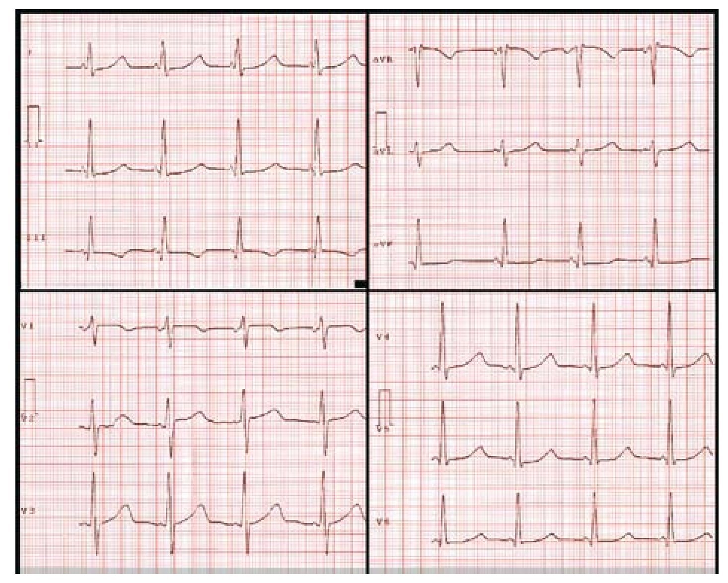 Association of Short PR Interval, Long QT Interval, and Sudden Cardiac ...