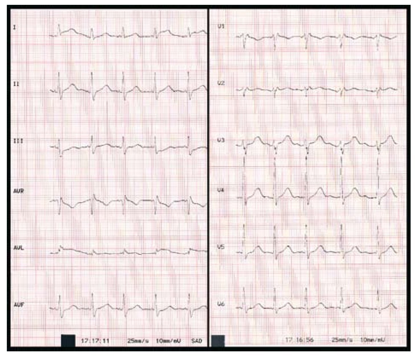 Association of Short PR Interval, Long QT Interval, and Sudden Cardiac ...