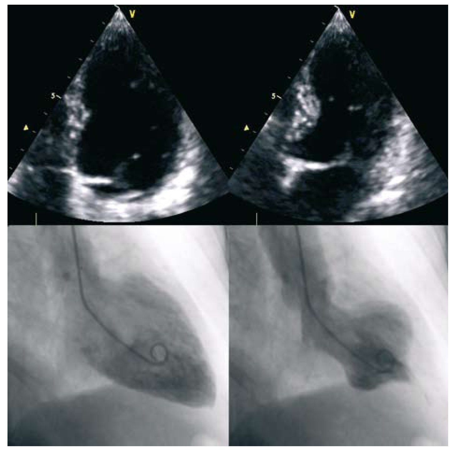 Tako-Tsubo Syndrome. Atypical Presentation | Revista Española de ...