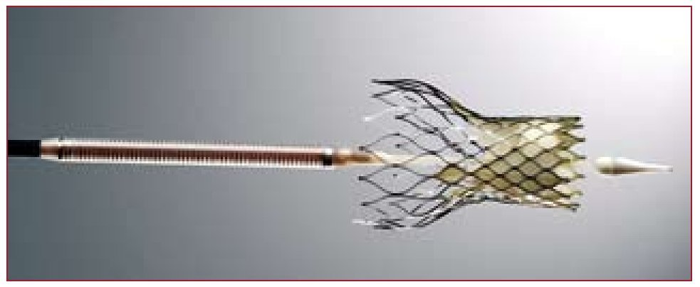 Progress in Transcatheter Aortic Valve Implantation | Revista Española ...