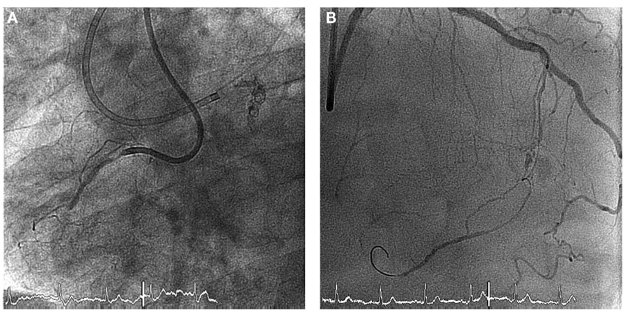 Retrograde Angioplasty: An Option for Total Coronary Artery Occlusions ...