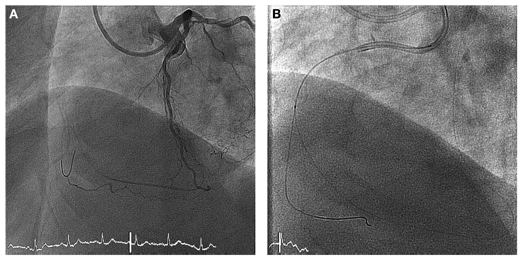 Retrograde Angioplasty: An Option for Total Coronary Artery Occlusions ...