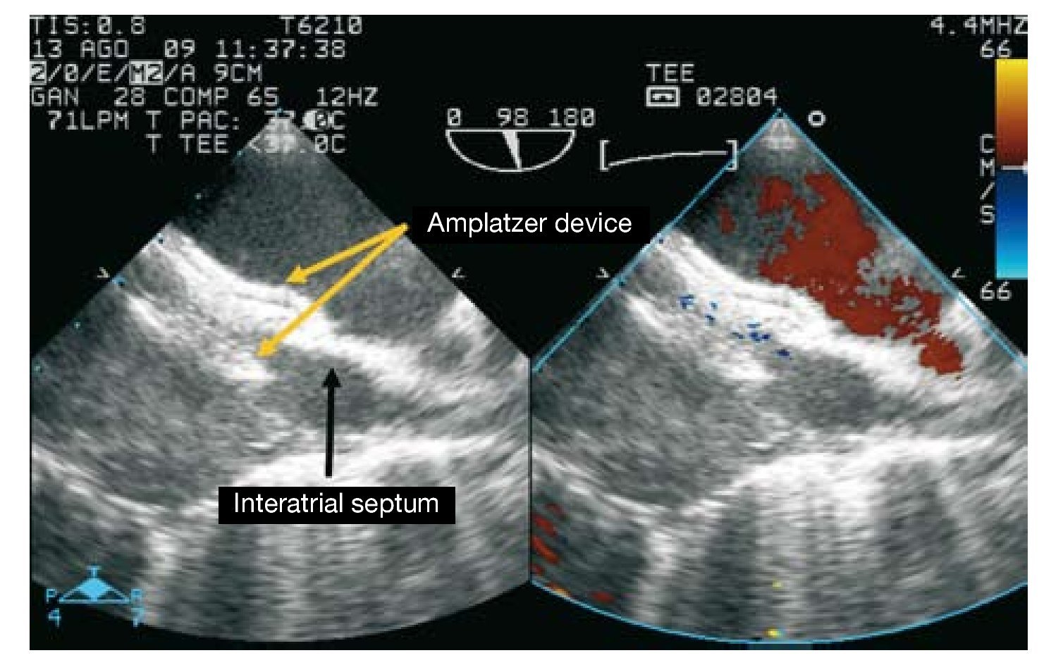 Cobra-Like Deformation of Amplatzer Devices Used for Closing Atrial ...