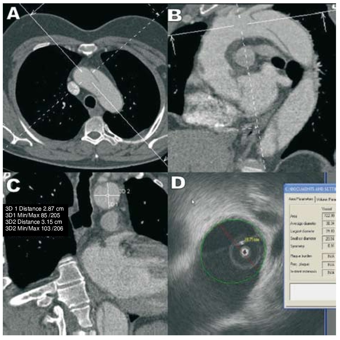 Intravascular Ultrasound Measurement of the Aortic Lumen | Revista ...