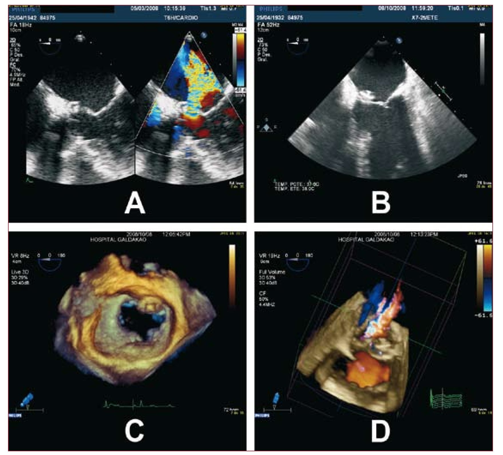 Percutaneous Closure of a Native Mitral Valve Perforation | Revista ...