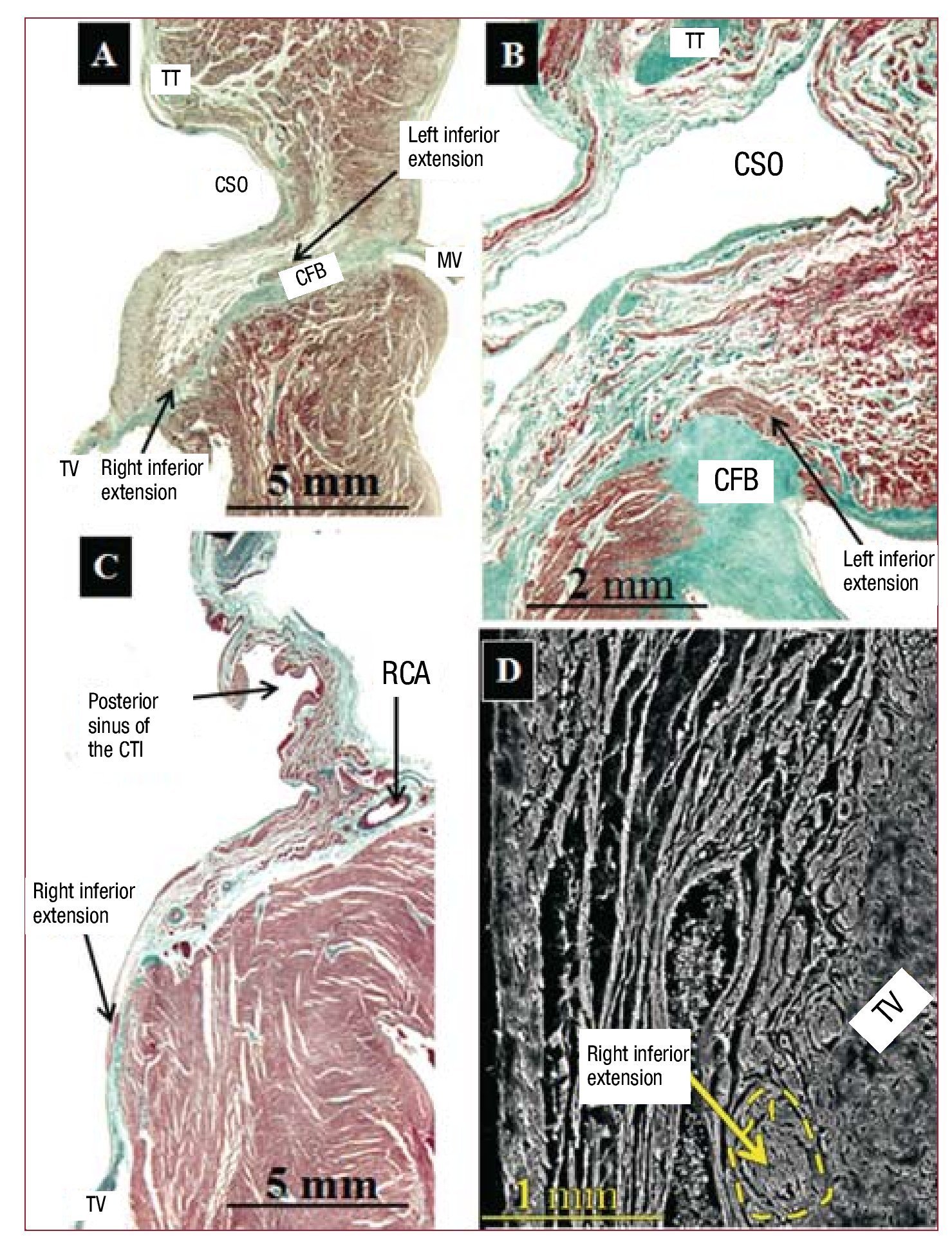 koch triangle av node