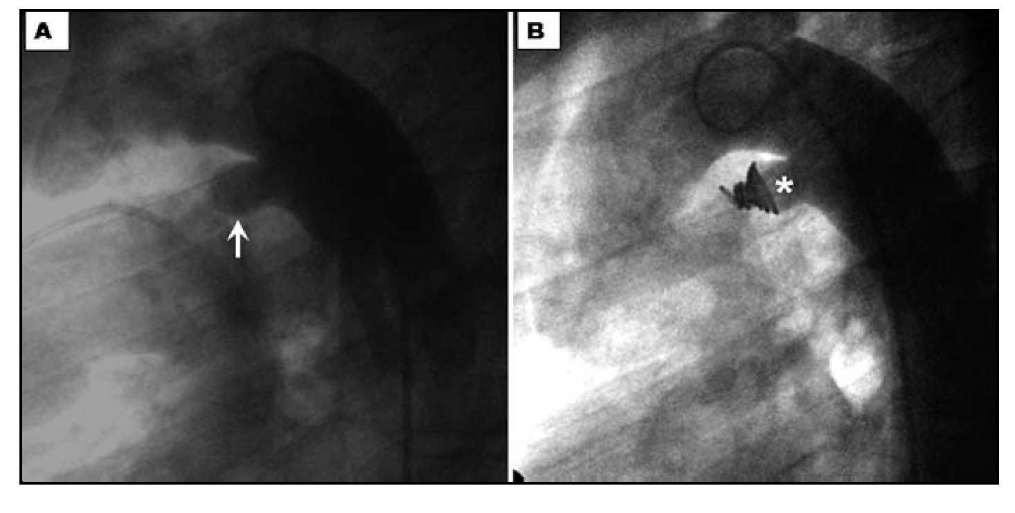 Percutaneous Closure of Patent Ductus Arteriosus in Adults Using ...