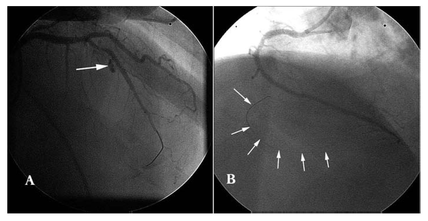 Coronary Artery Perforation by Intracoronary Guide Wires: Risk Factors ...