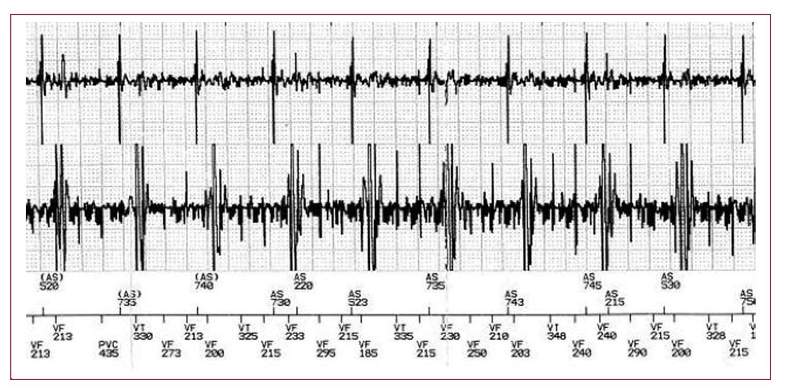 Nuclear Magnetic Resonance Imaging in Patients With Cardiac Pacing ...