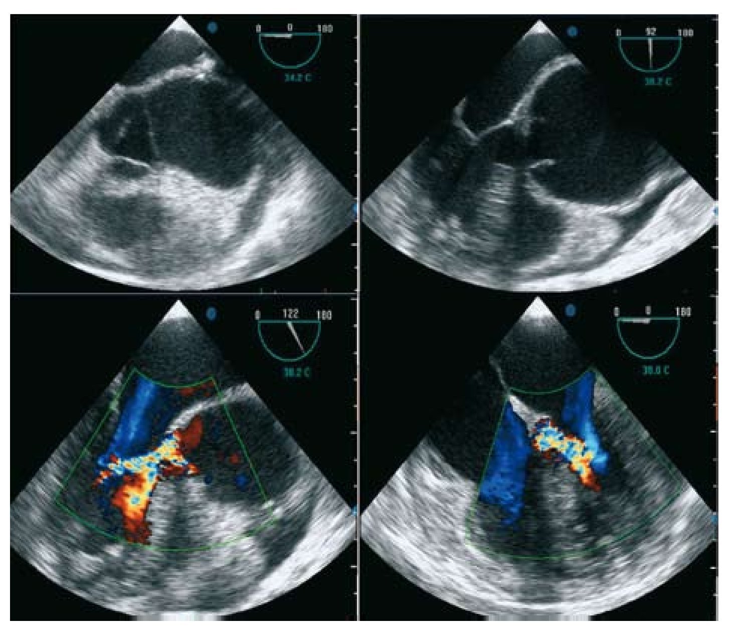 Rupture of a Left Sinus of Valsalva Aneurysm Into the Pericardial ...