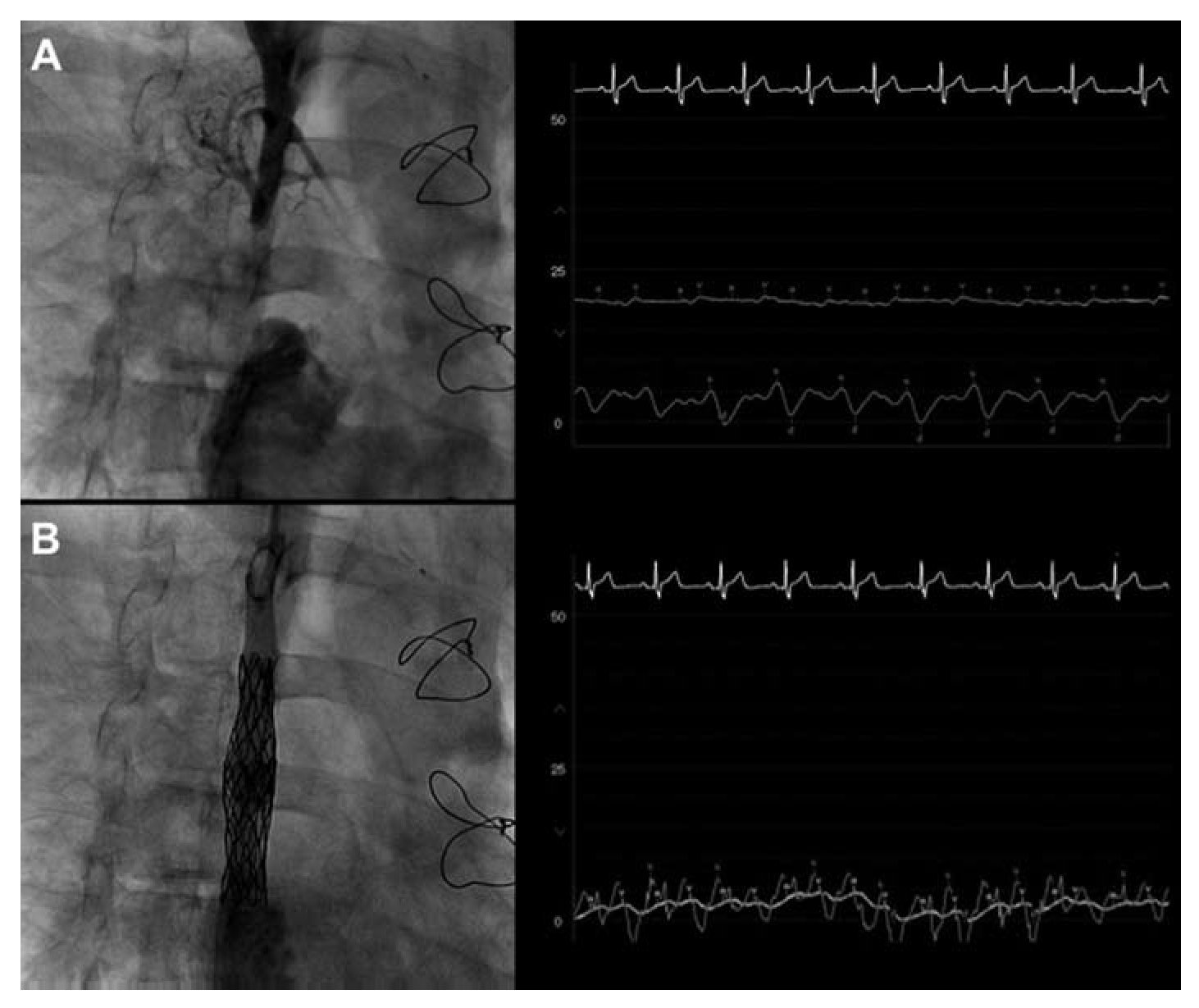 Percutaneous Treatment of Superior Vena Cava Obstruction After Surgery ...