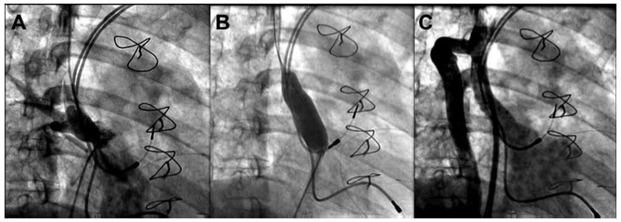 Percutaneous Treatment of Superior Vena Cava Obstruction After Surgery ...