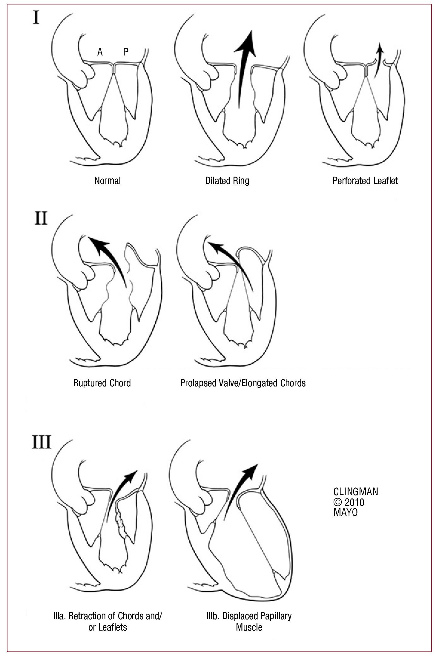 Progress in the Treatment of Severe Mitral Regurgitation | Revista ...