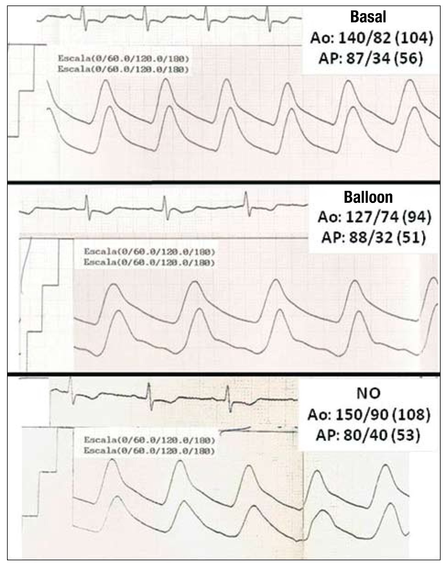 Atrial Septal Defect With Severe Pulmonary Hypertension in Elderly ...
