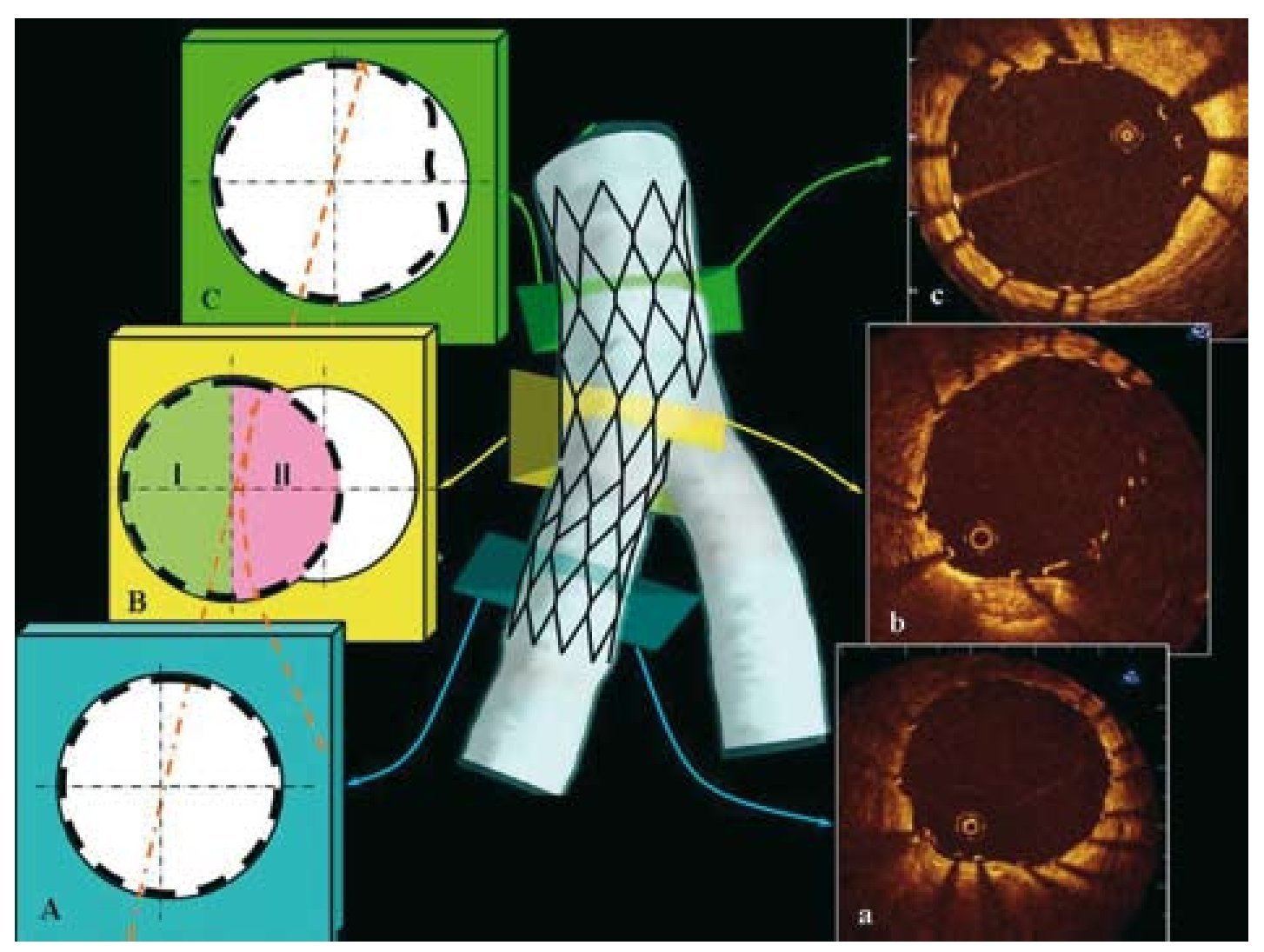 Simple Versus Complex Approaches to Treating Coronary Bifurcation ...