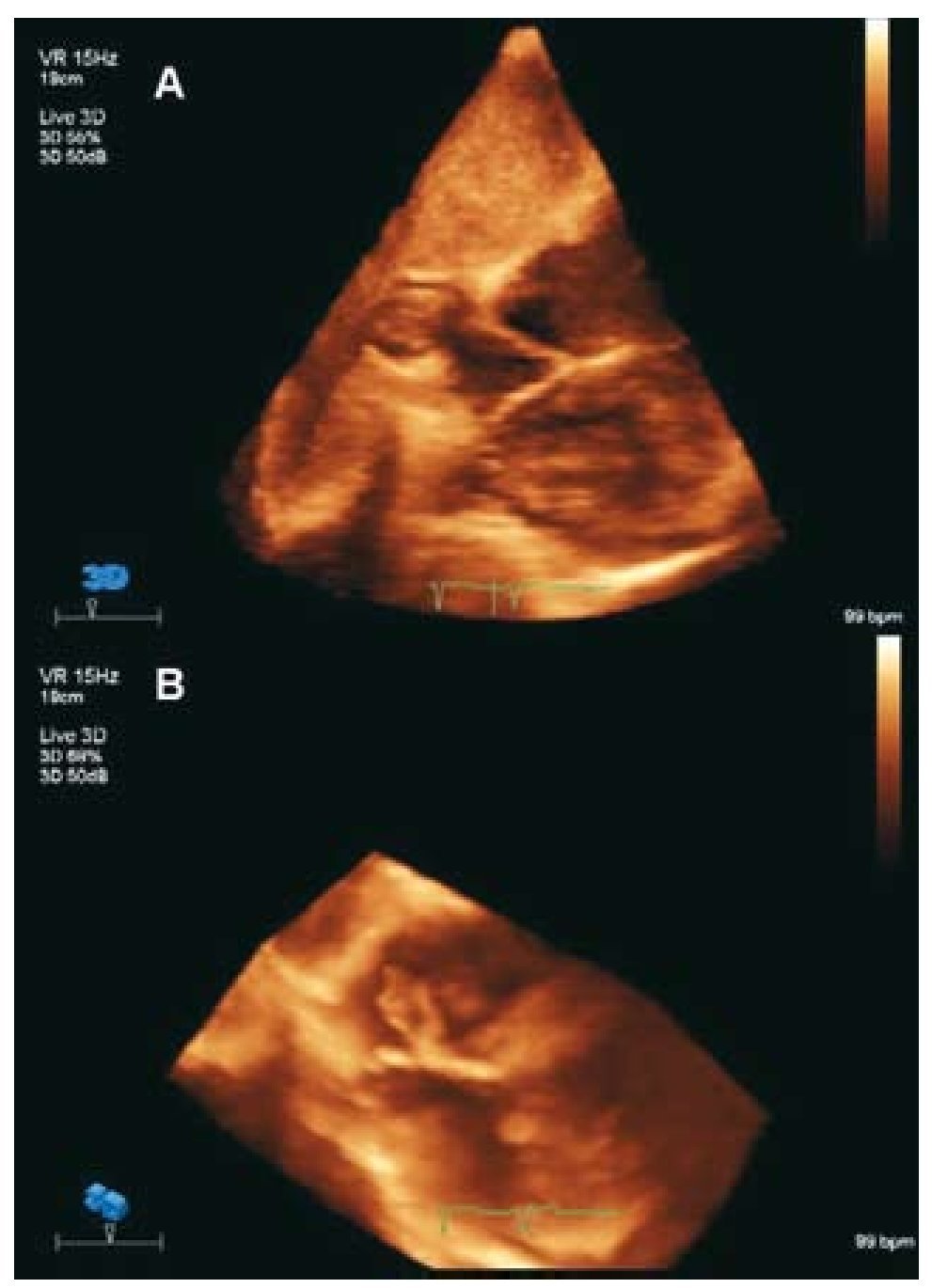 Cor Triatriatum Dexter in Adults | Revista Española de Cardiología