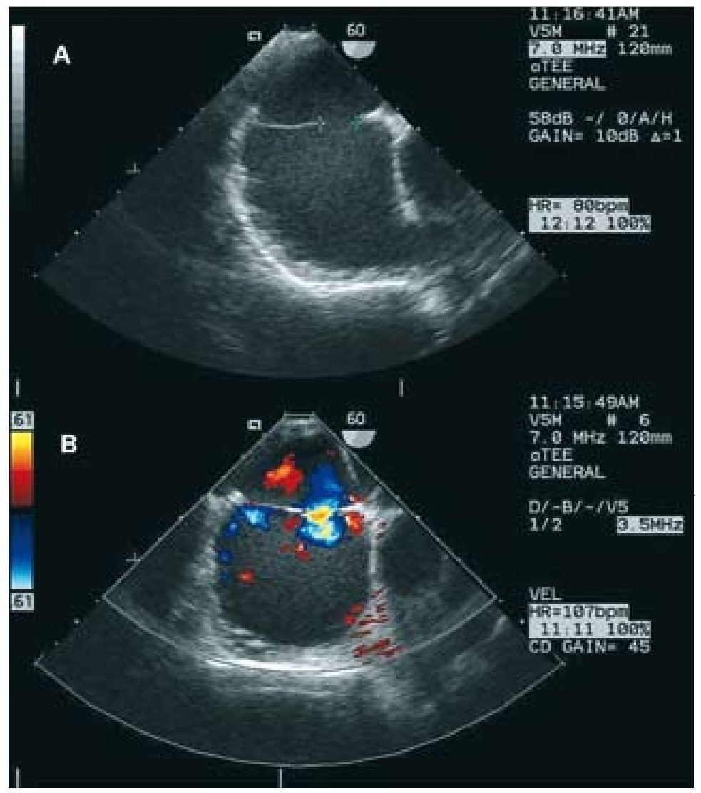 Cor Triatriatum Dexter in Adults | Revista Española de Cardiología
