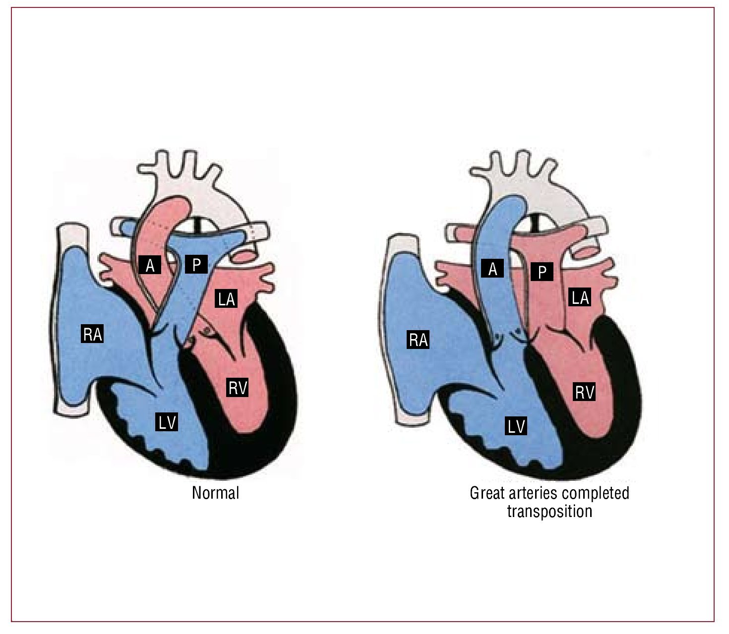 The Right Heart in Adults With Congenital Heart Disease | Revista ...