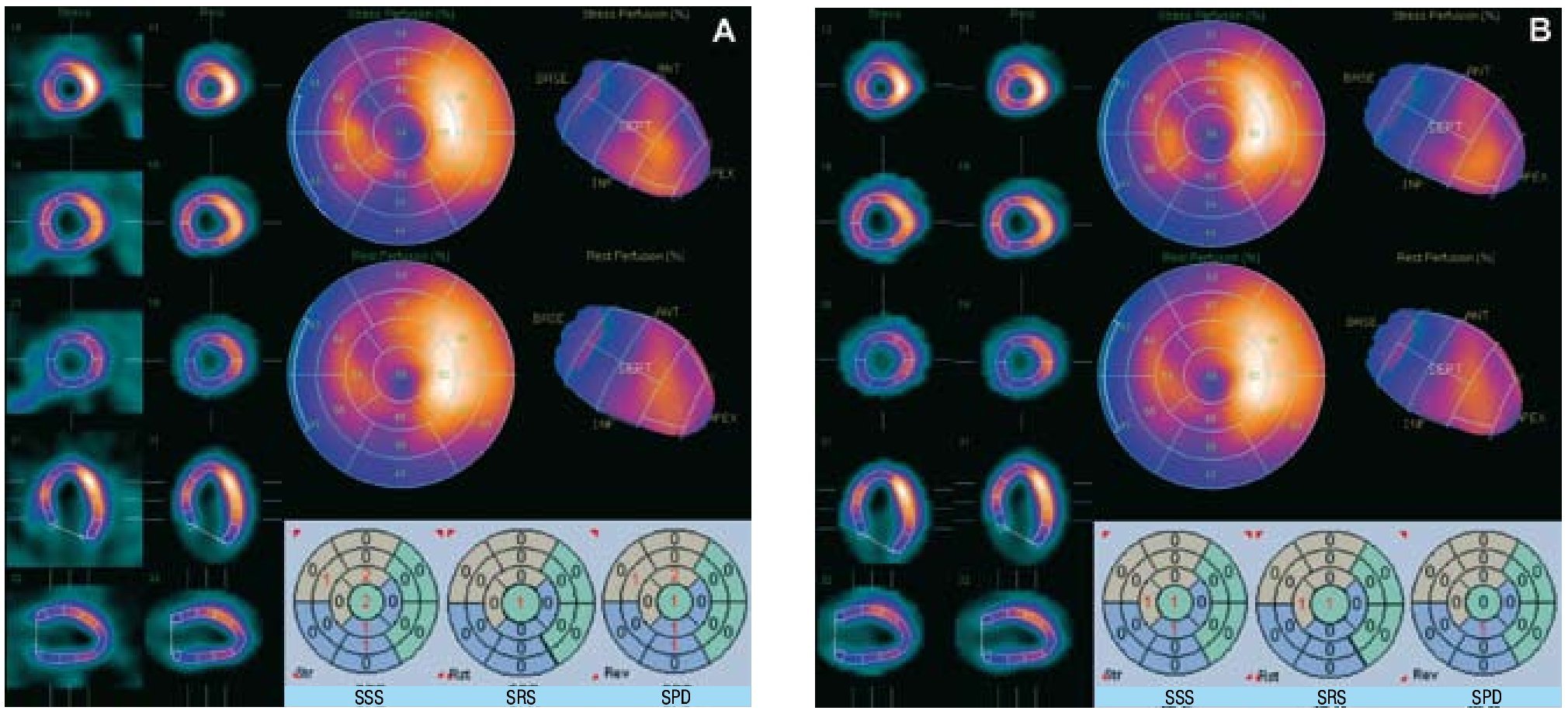 Submaximal Exercise Testing Plus Atropine in Myocardial Perfusion SPECT ...