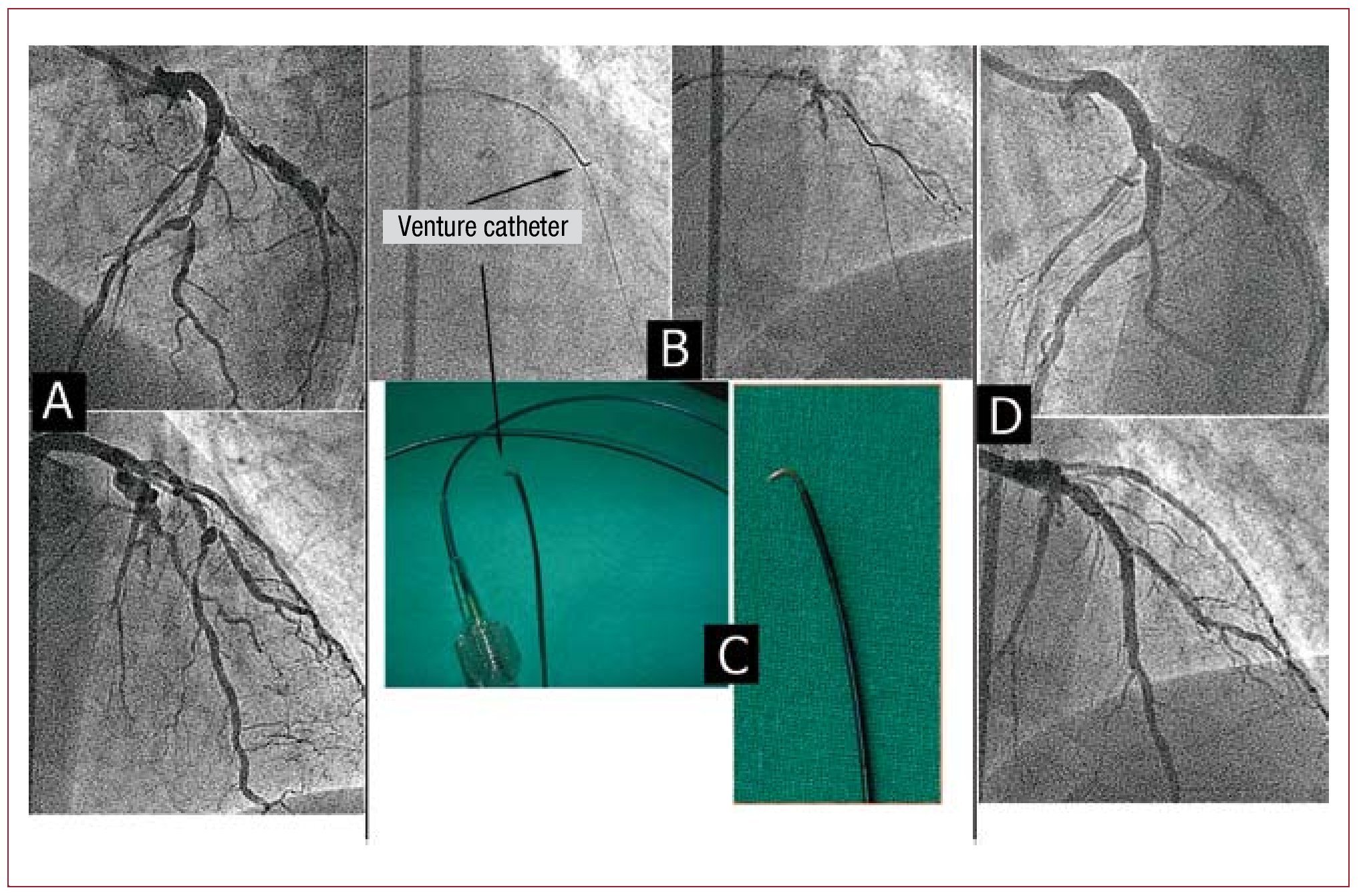 Use of the Venture Wire-Control Catheter for Accessing Side Branches ...