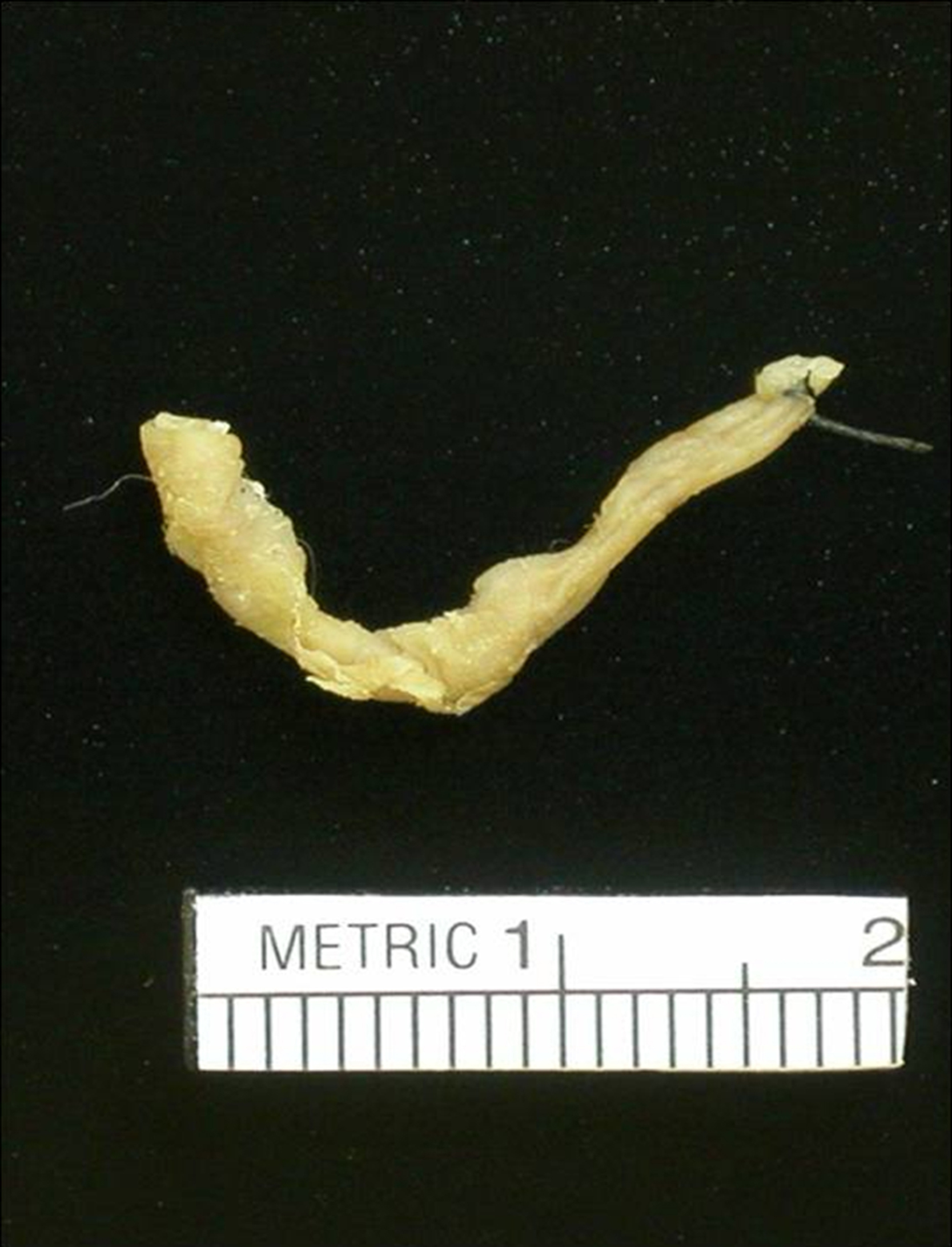 Radial Artery Avulsion: A Rare Complication of Percutaneous Coronary ...
