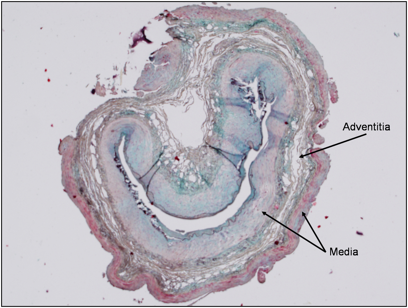 Radial Artery Avulsion: A Rare Complication of Percutaneous Coronary ...